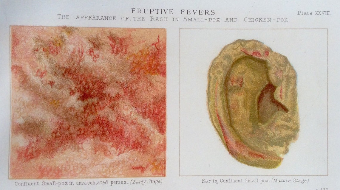 Antique Print Anatomy Bookplate Chromolithograph Small Pox Disease ...