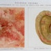 Antique Print Anatomy Bookplate Chromolithograph Small Pox Disease ...