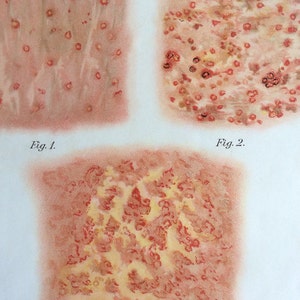 Vintage 1907 German Medical Anatomy Diagram Bookplate Skin Disease ...