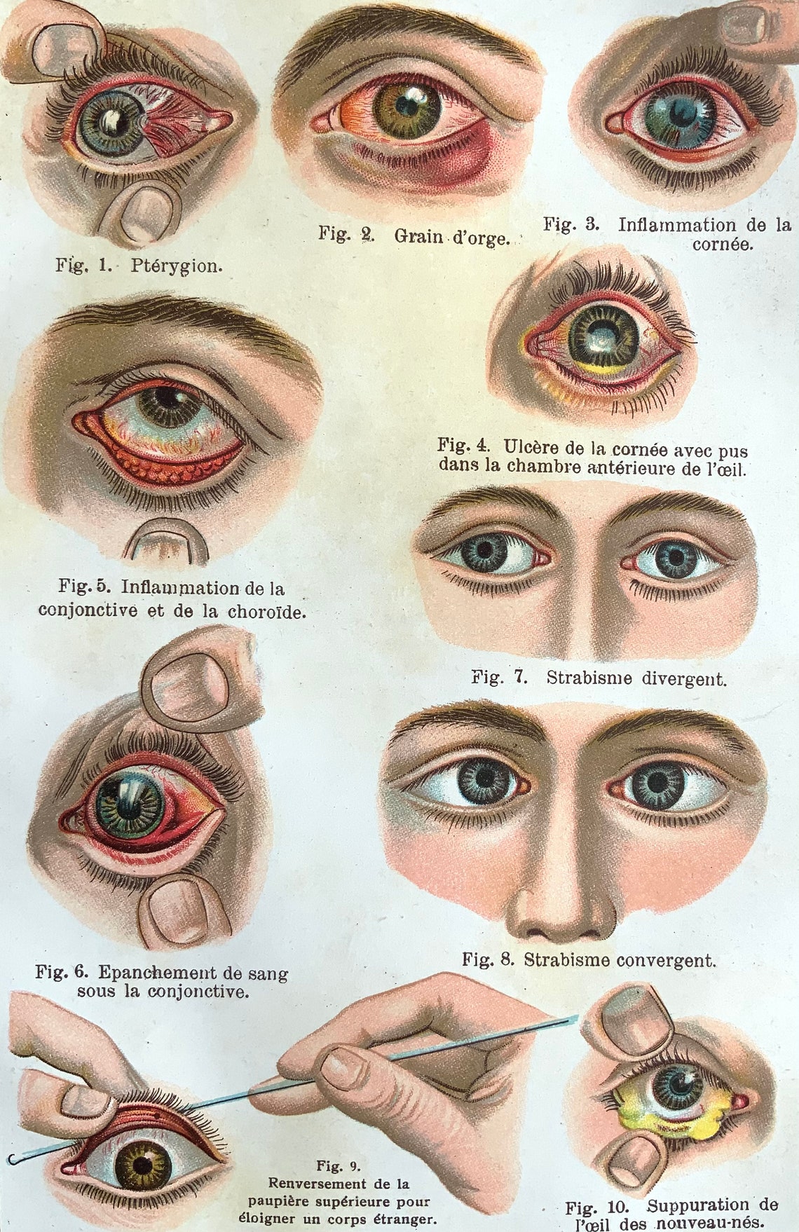 Antique BOSS-EYED Print French Anatomy Bookplate Circa 1900 | Etsy