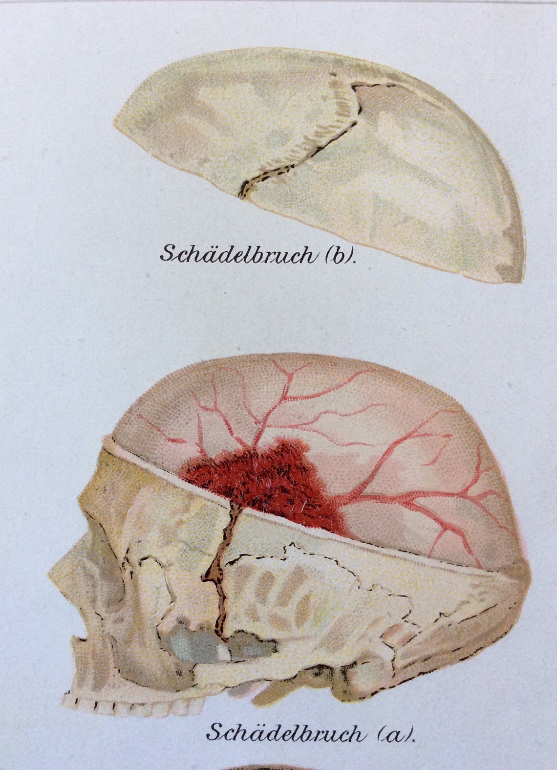 Vintage 1905 German MUSCLE BONE FRACTURE Medical - Etsy