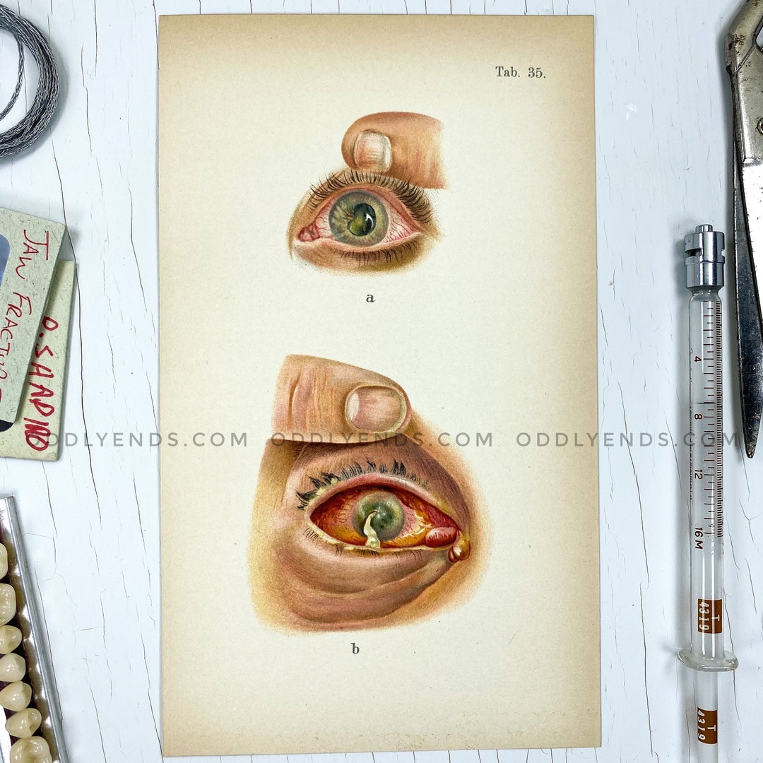 1900's Eye Infection, Not Reproduction, Vintage Publication, Medical ...