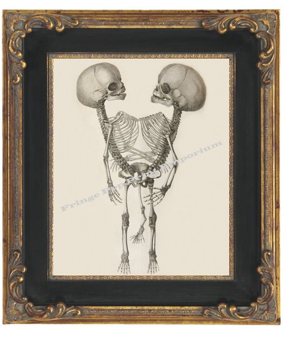 Home Décor Korean Siamese Twins Victorian Sideshow Circus Freak Art ...