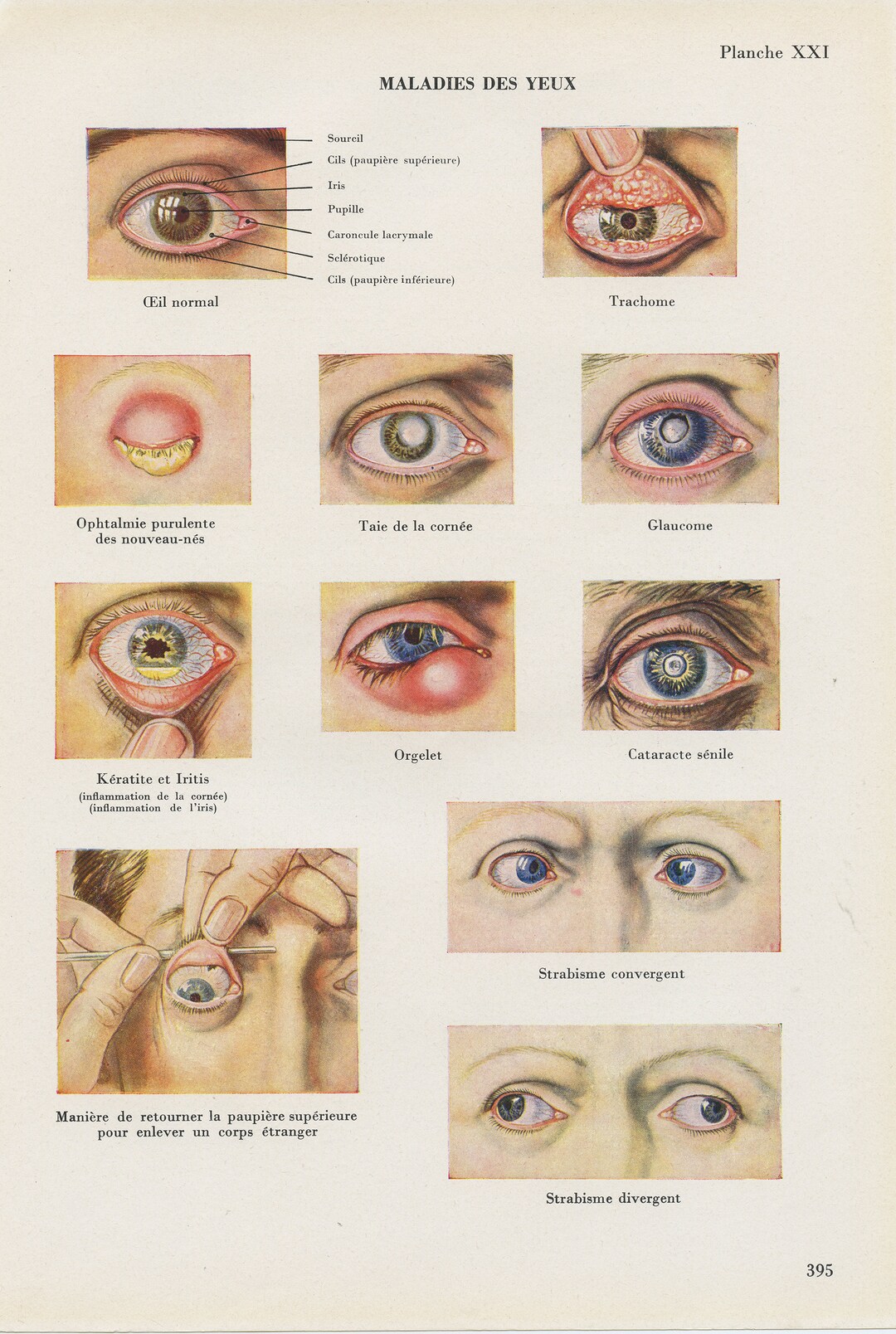 1962 Small Eye Anatomy Print. Antique French Vintage Medical ...
