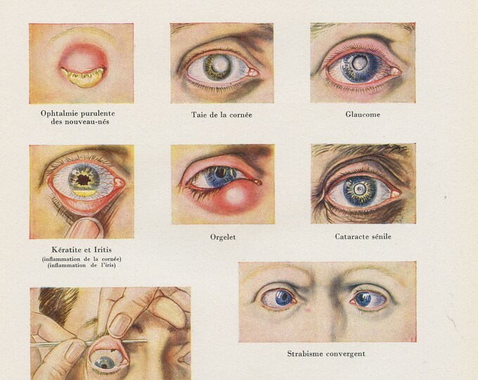 1962 Small Eye Anatomy Print. Antique French Vintage Medical ...