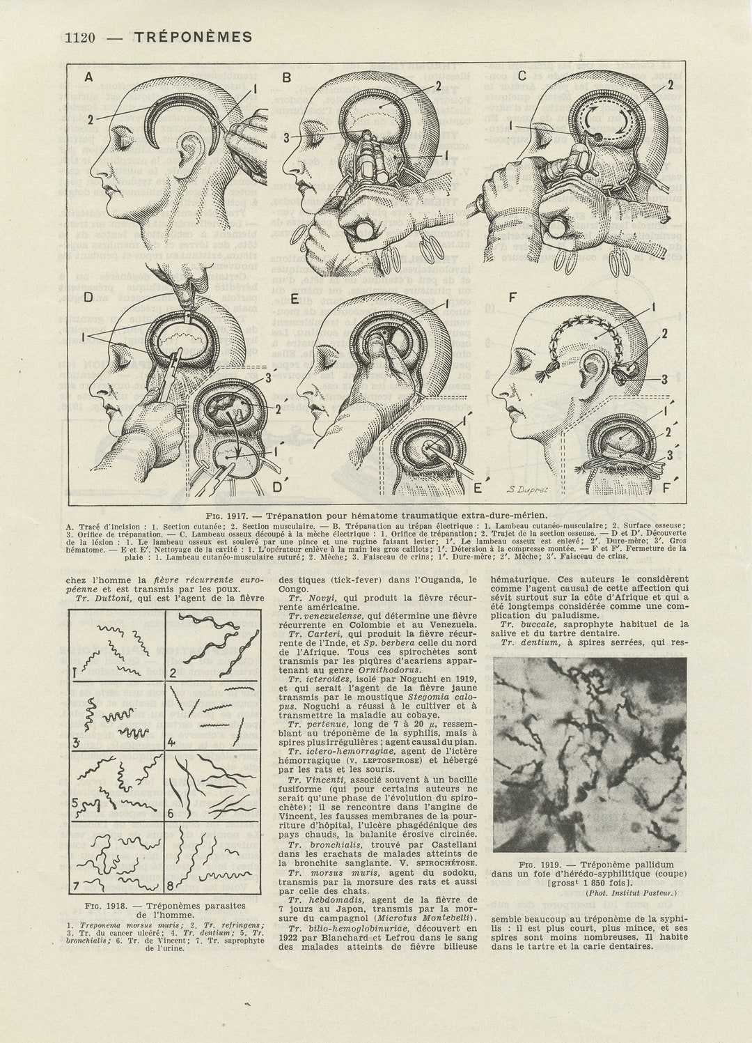 1952 Trepanation Print Gift for Doctor Office Decor. French - Etsy