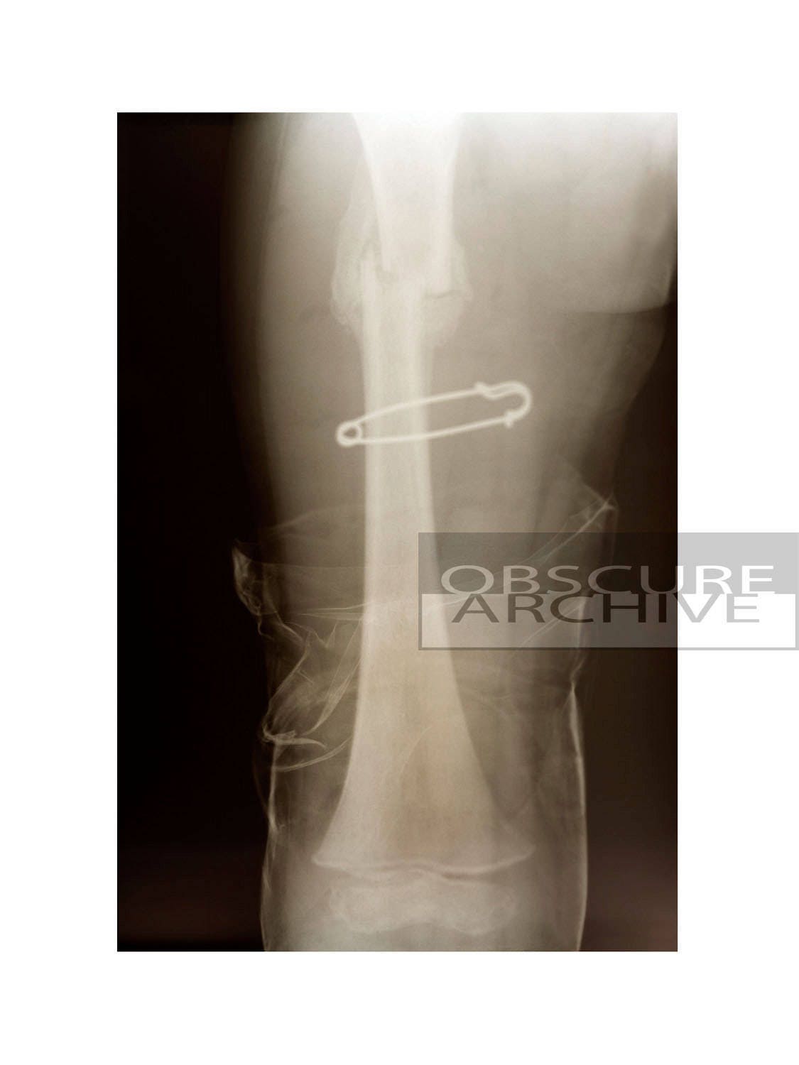 Radiografía De Pierna Rota Humana