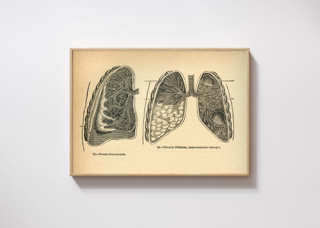 Human Anatomical Lungs Art Print - 1895 Pneumonia Etching Medical Wall ...