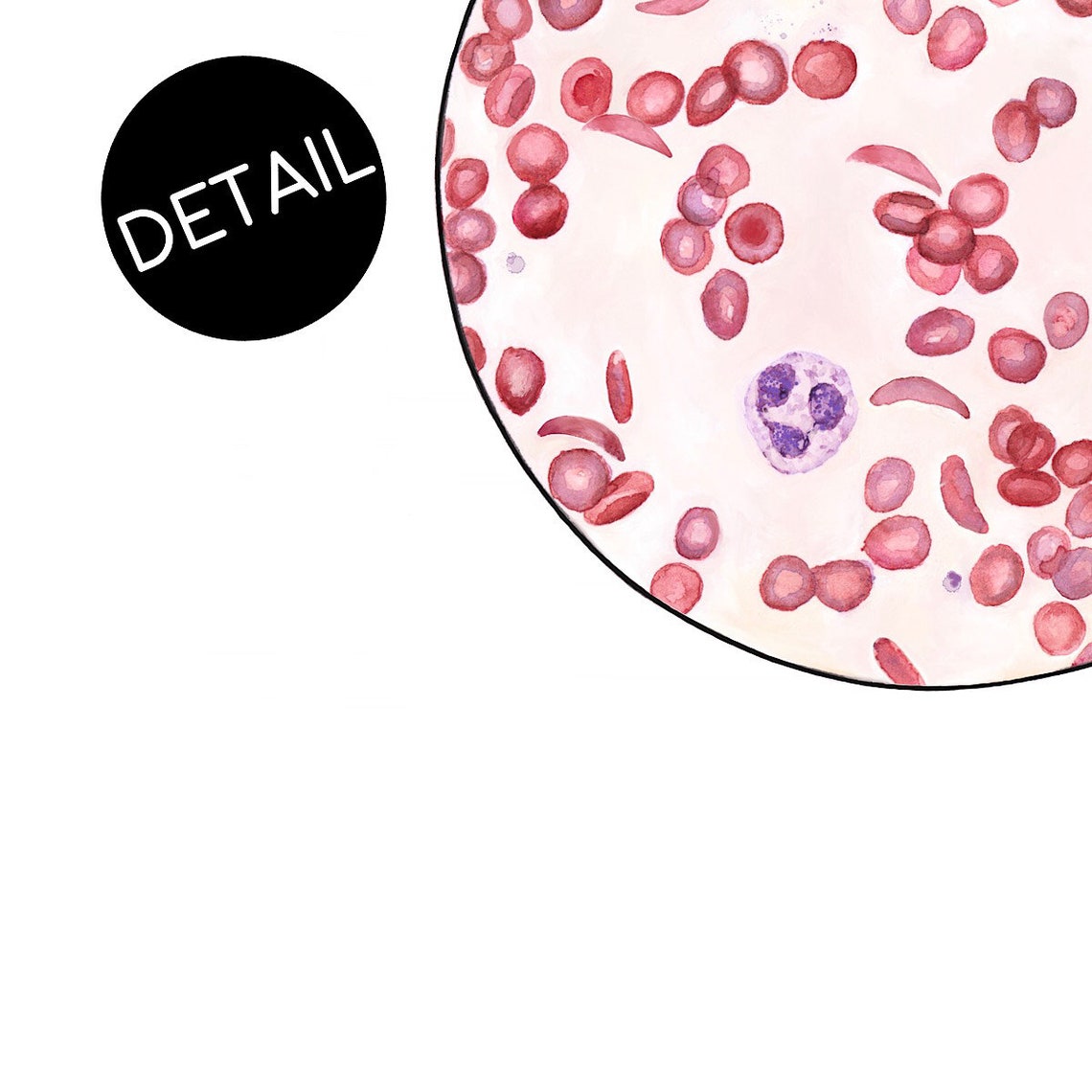 Sickle Cell Anemia Science Art Biology Art Science | Etsy