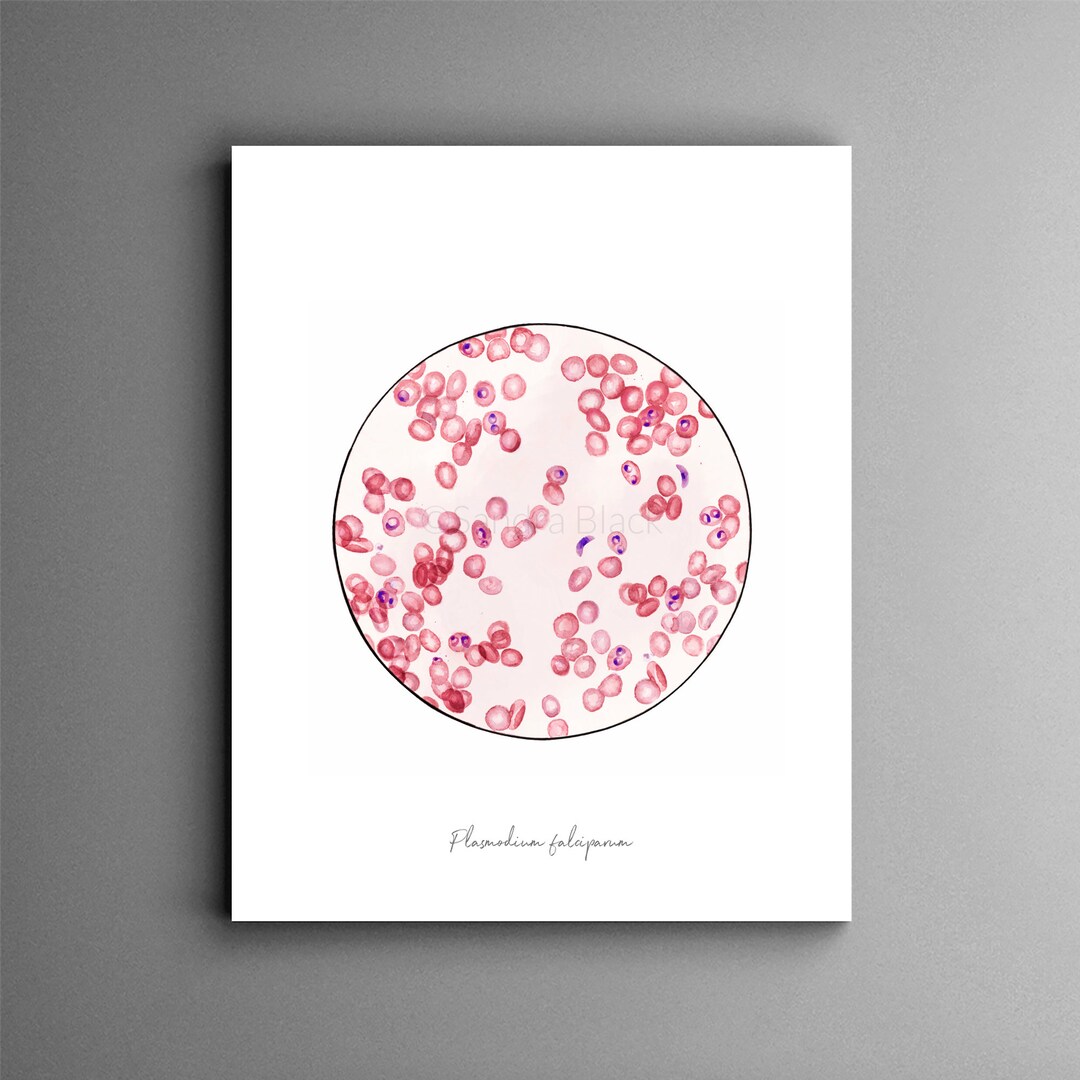 Plasmodium Falciparum, Malaria, Medical Art, Biology Art, Medical Print ...