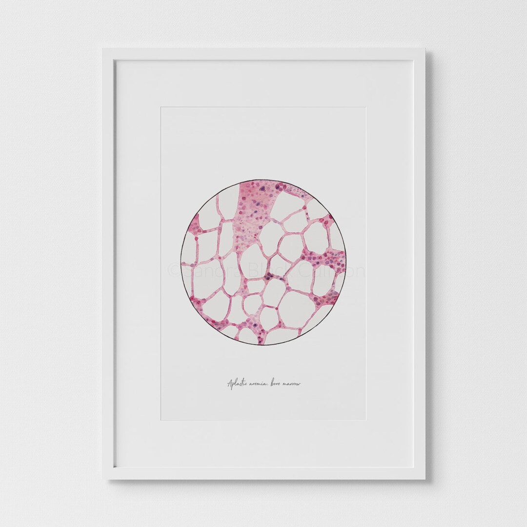 Aplastic Anemia Bone Marrow Histology Histology Art Science Art