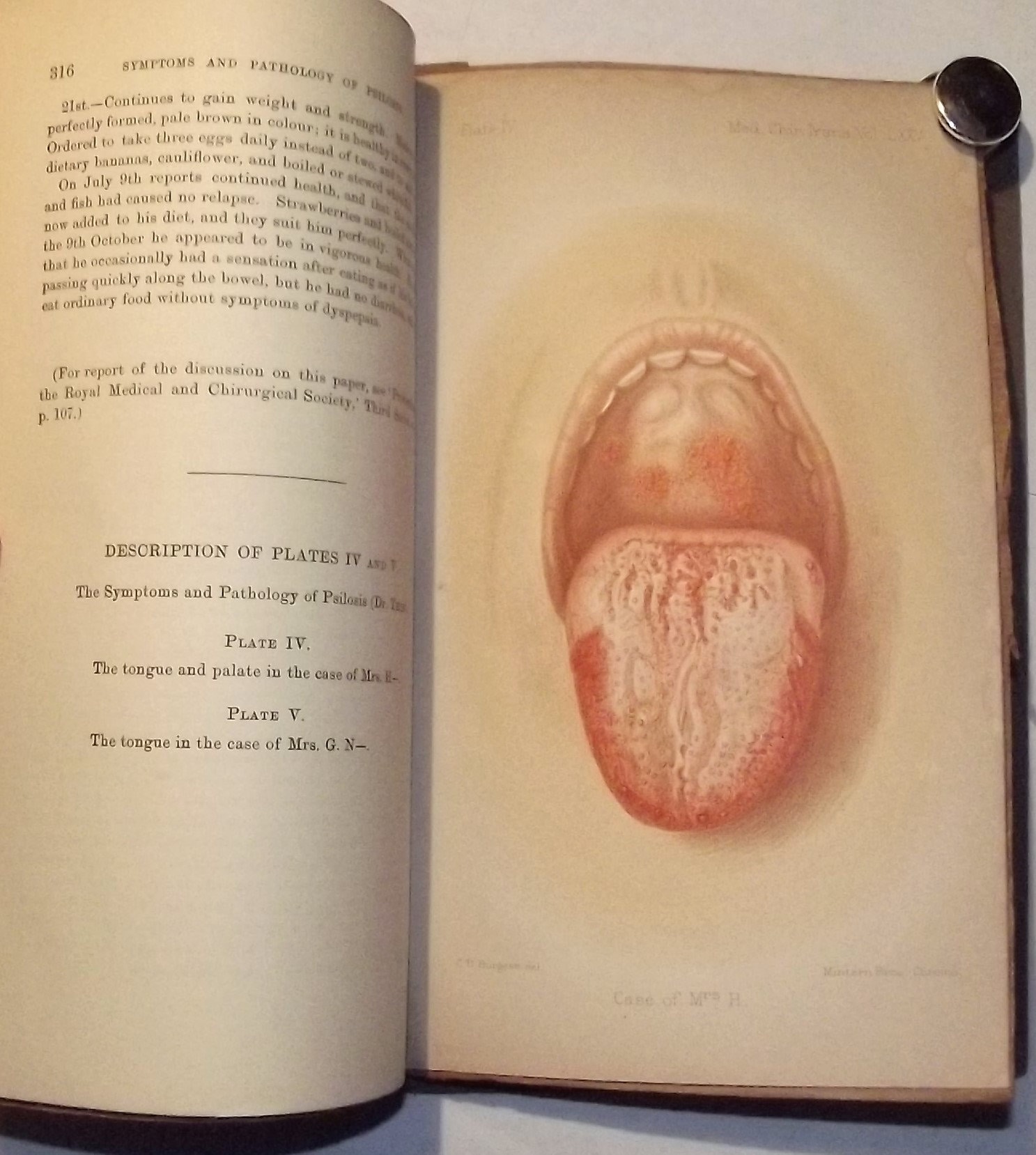 On the Symptoms and Pathology of Psilosis rare 1892 Medical Book - Etsy