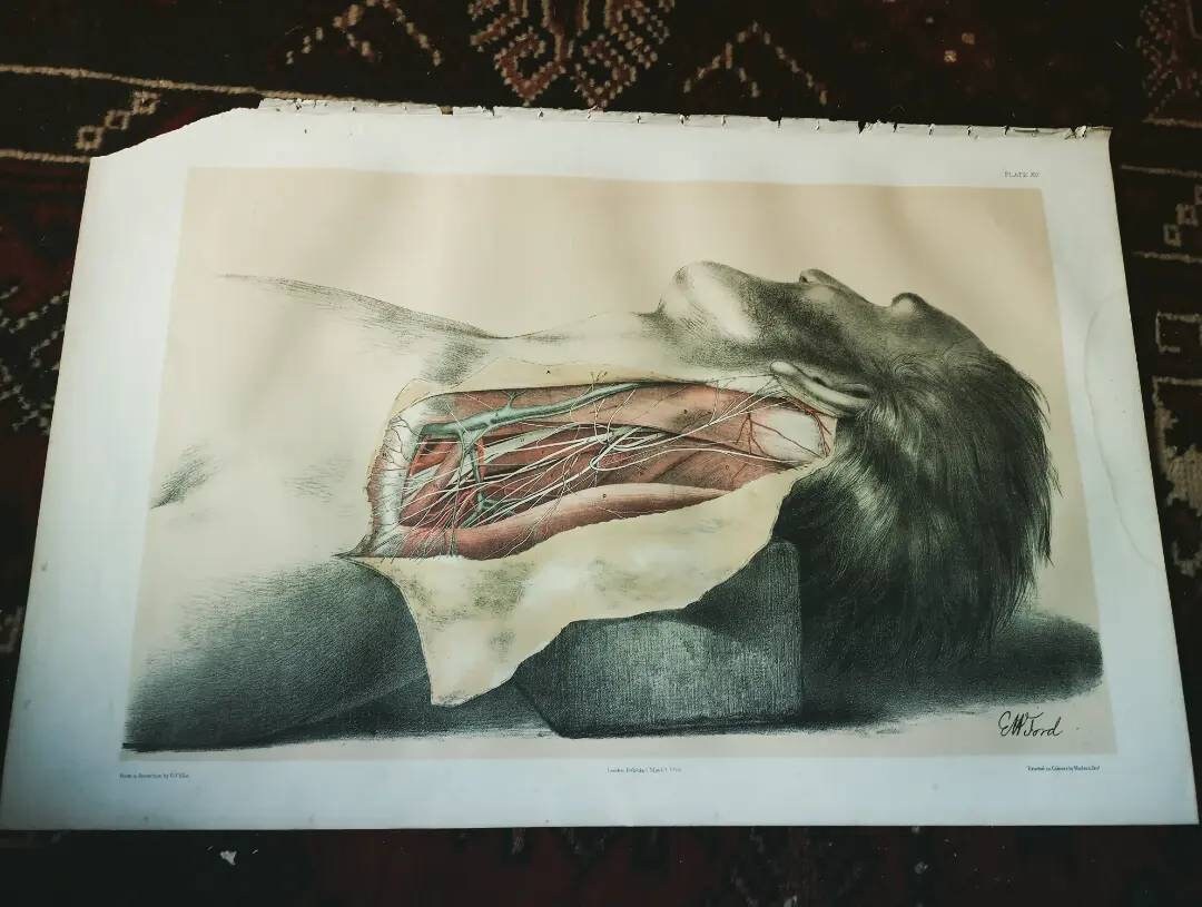 Massive Original, Ready to Frame Anatomical Dissection Lithograph Print ...