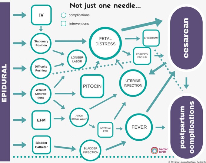 Epidural Flow Chart-cascade of Interventions-printable Birth Education ...