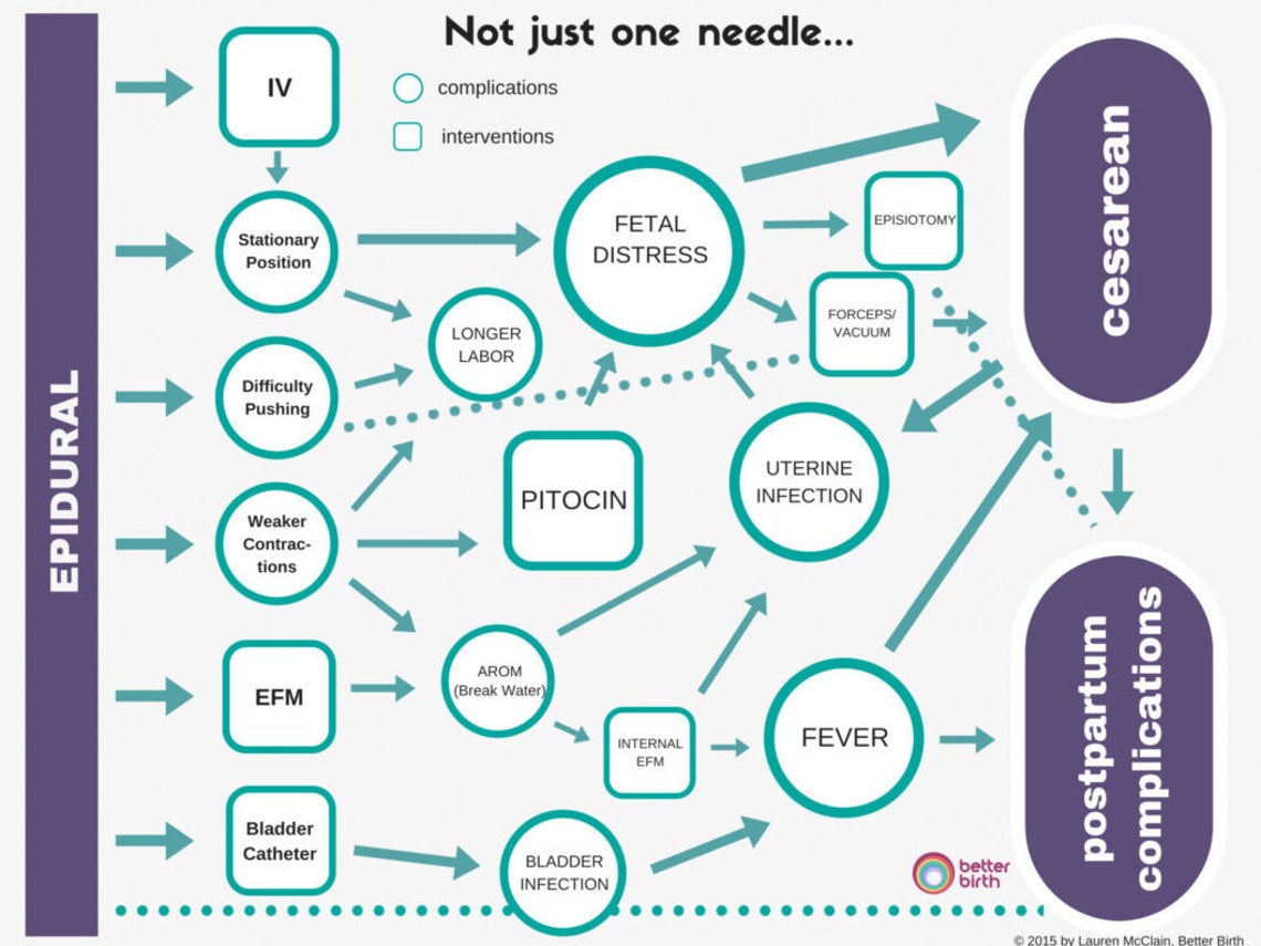Epidural Flow Chart-cascade of interventions-printable birth | Etsy Epidural Flow Chart-cascade of interventions-printable birth | Etsy