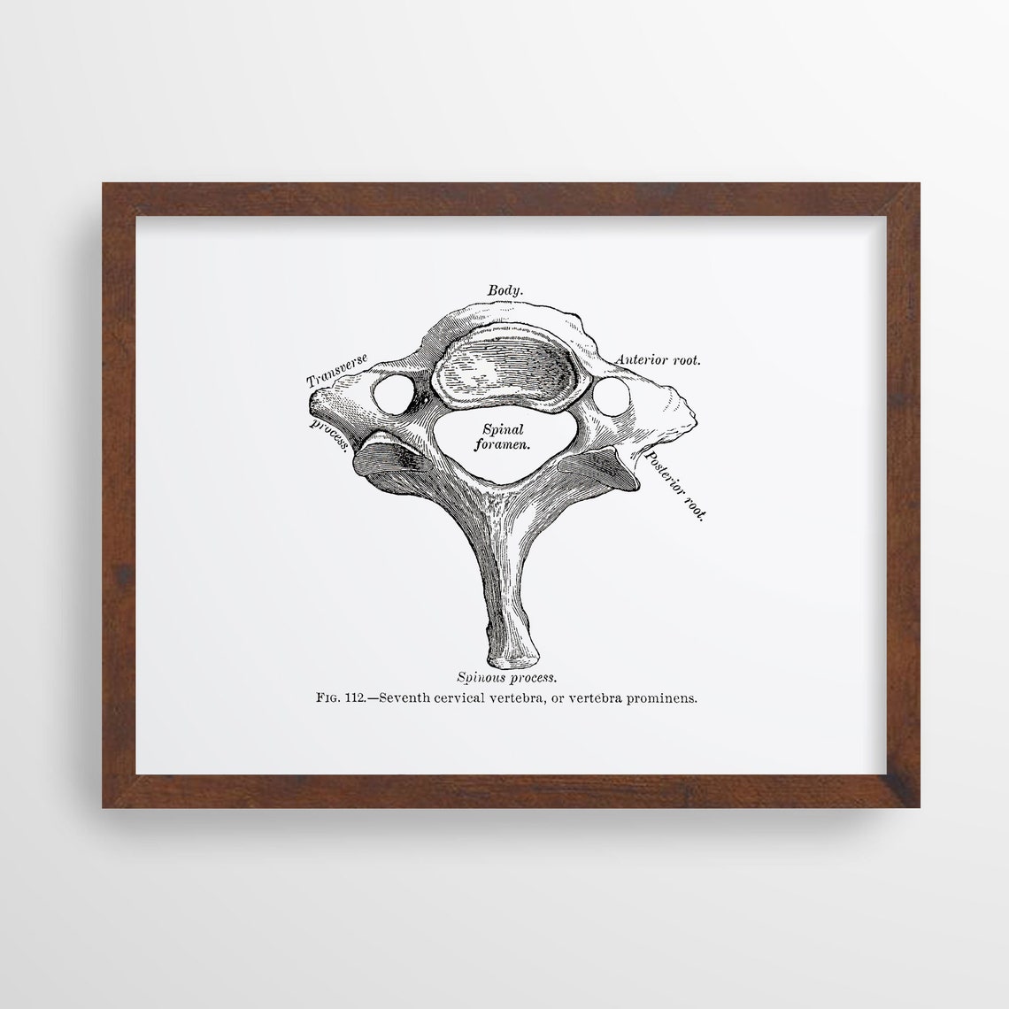 Vertebra Prominens Cervical Spine Bone Vintage Osteology Human Anatomy ...