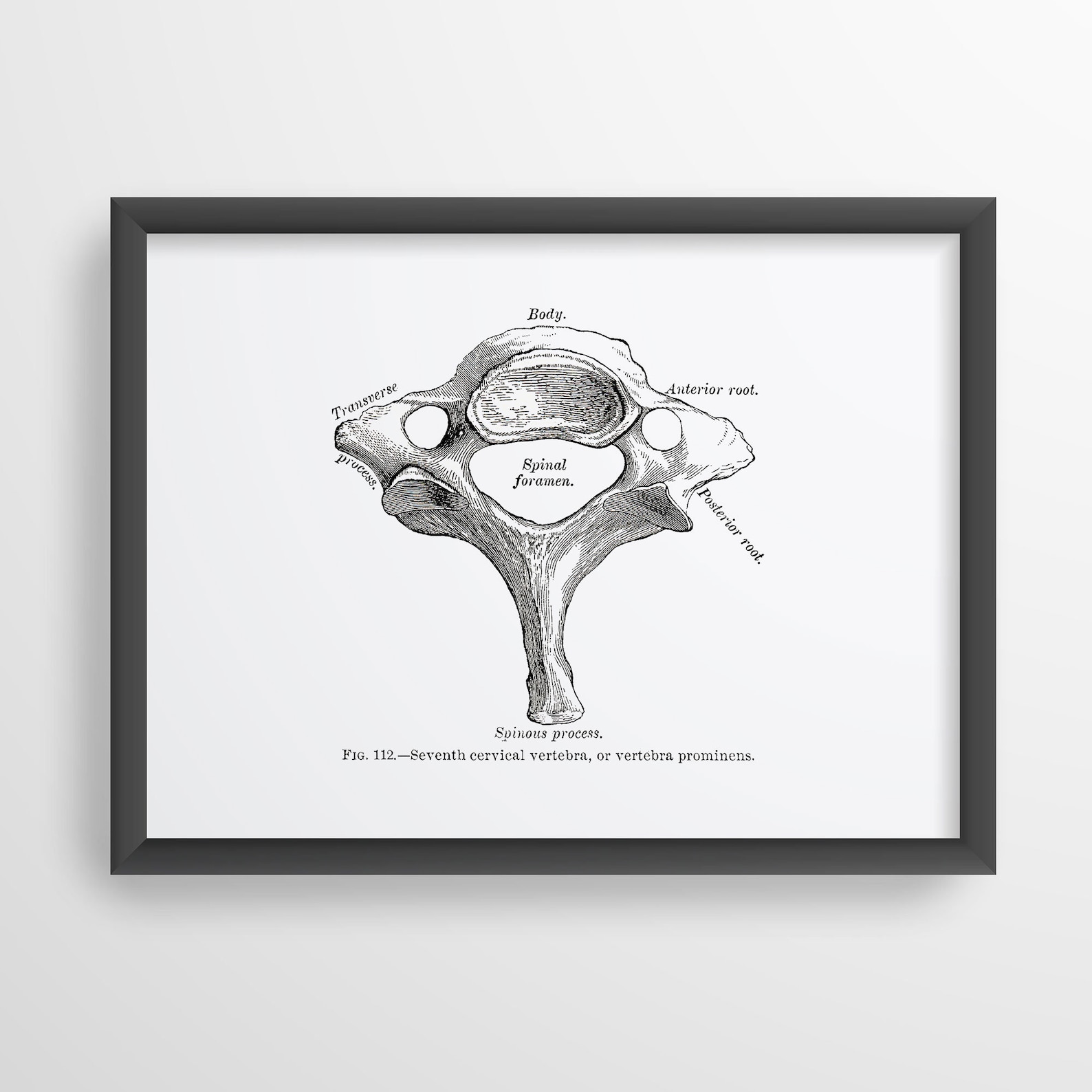 Vertebra Prominens Cervical Spine Bone Vintage Osteology Human Anatomy ...