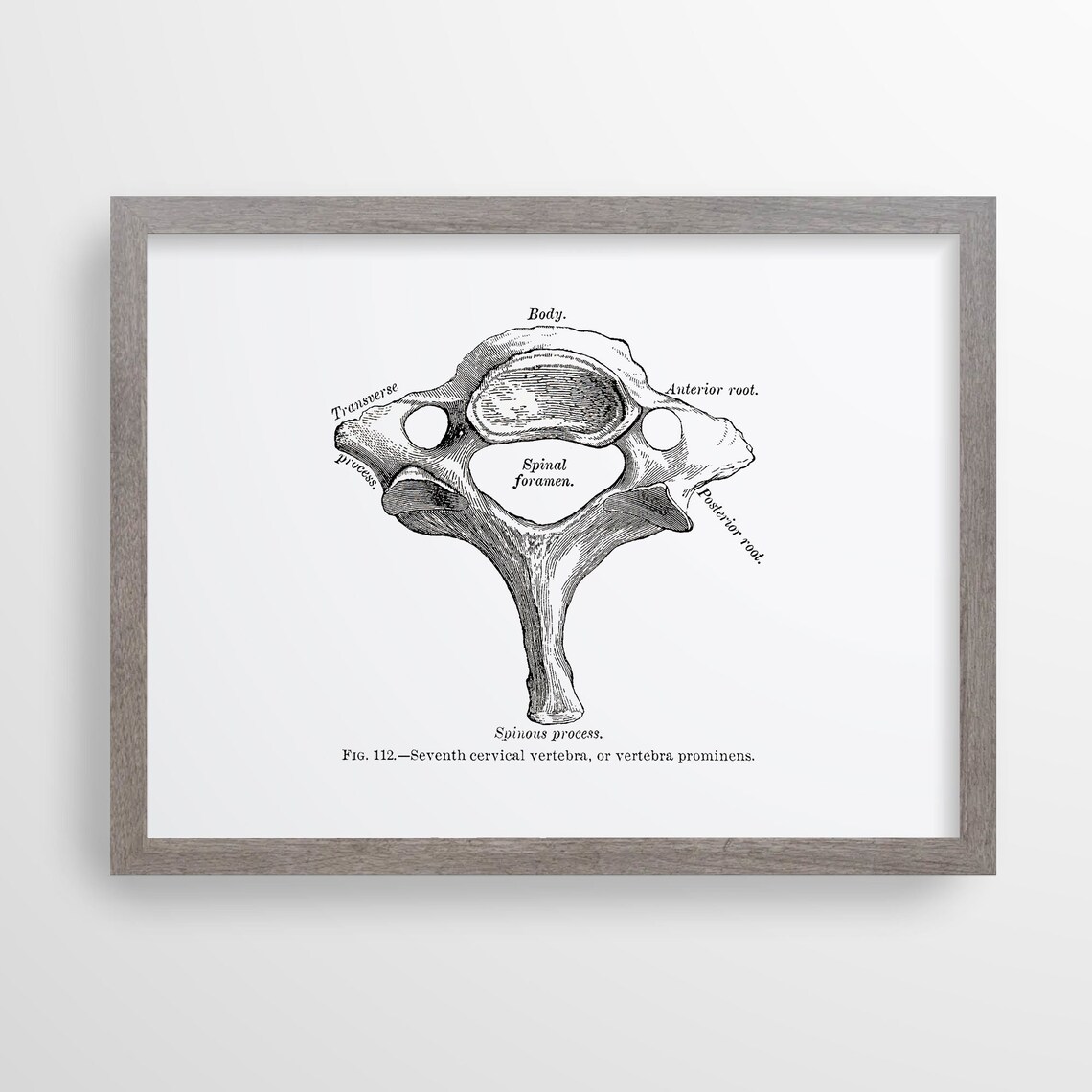Vertebra Prominens Cervical Spine Bone Vintage Osteology Human Anatomy ...