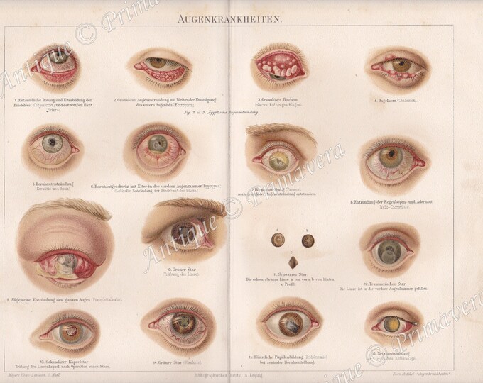 1893 Anatomy - Diseases of the Eye, Illness of Human Eye Original ...