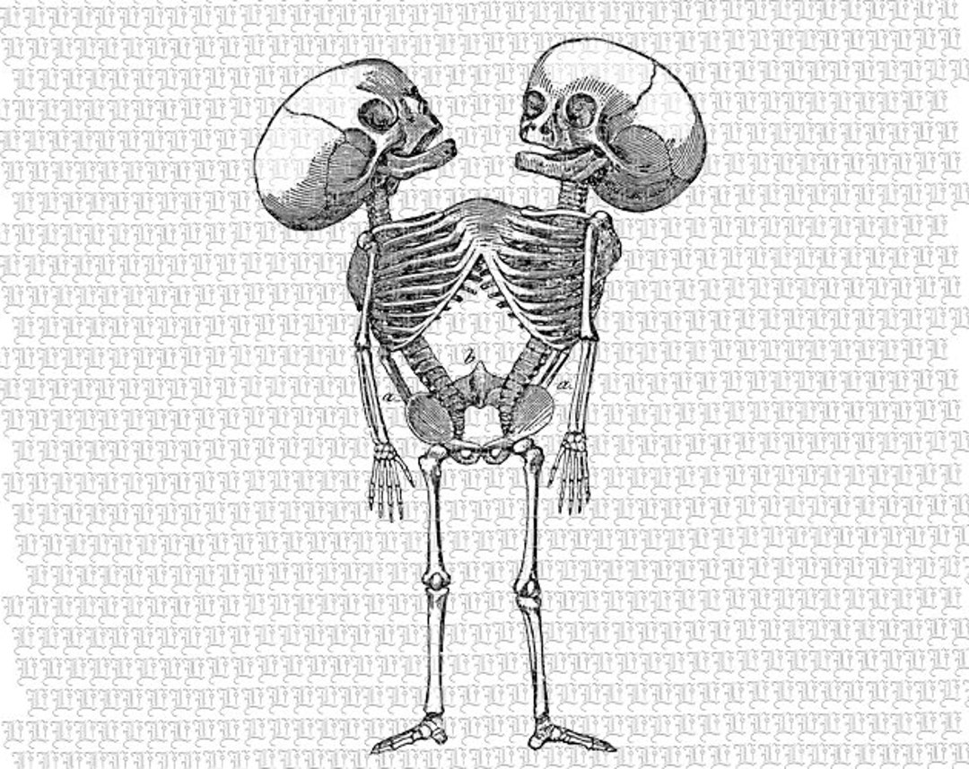 Siamese Conjoined Skeleton Twins Antique Vintage Clip Art Illustrations ...