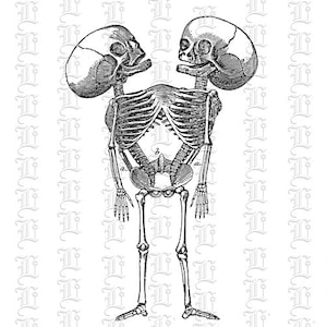 Siamese Conjoined Skeleton Twins Antique Vintage Clip Art Illustrations ...