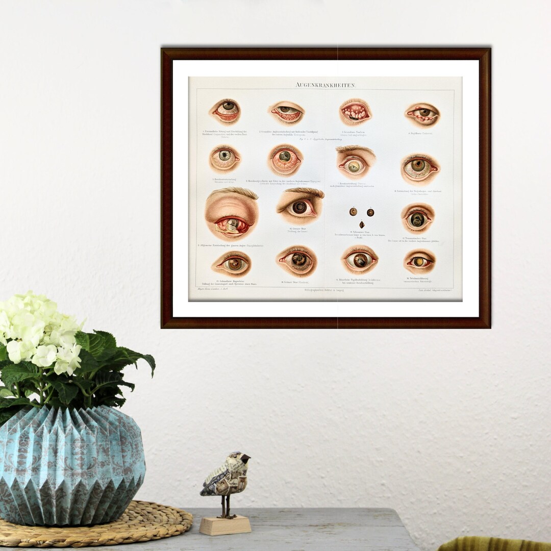 Eye Diseases Antique Lithograph From 1893 Vintage Poster - Etsy