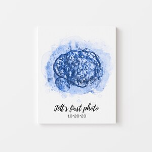 Embryo Art Custom Canvas Print IVF Baby Pregnancy Announcement IVF Art ...