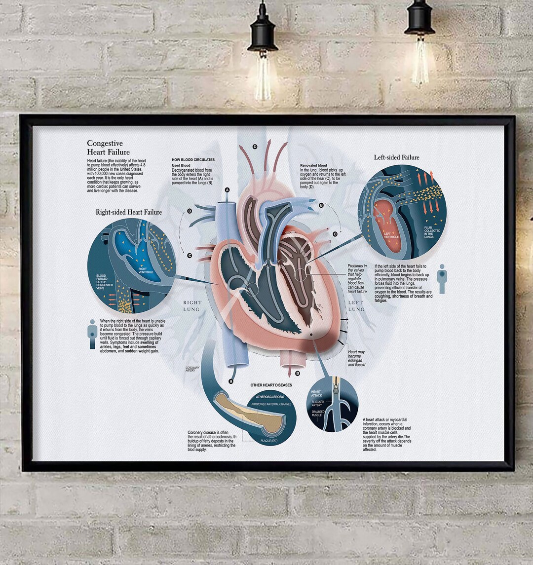 Congestive Heart Failure Poster or Canvas Heart Disease Chart - Etsy