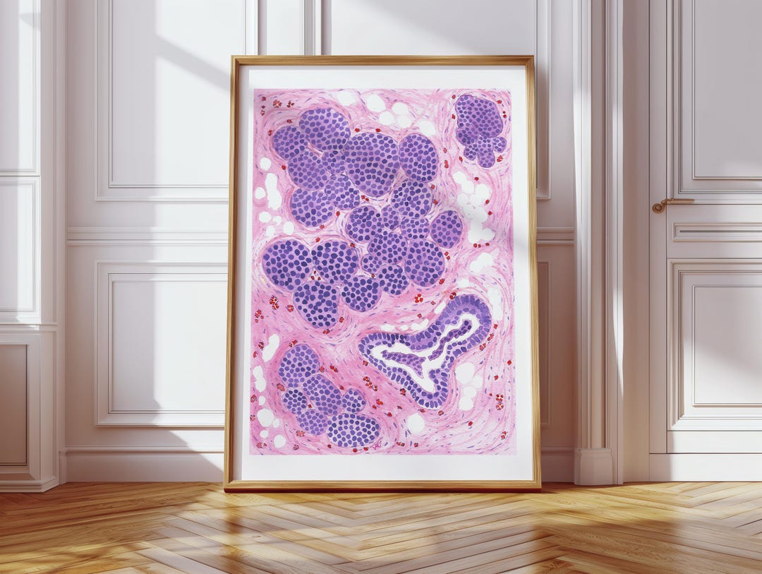 LCIS Histology, Breast Histology Art, Watercolor Art, Wall Art, Doctor ...