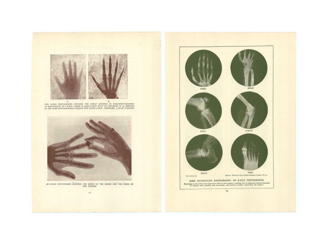 Set of 2 X-ray Prints. 1930s Vintage Lithograph Book Pages/plates. X ...
