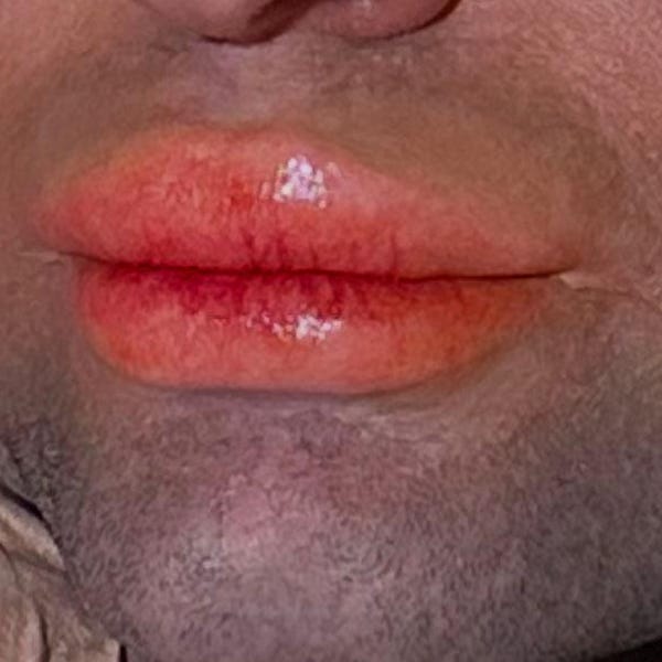 Prosthetic Lips - Etsy