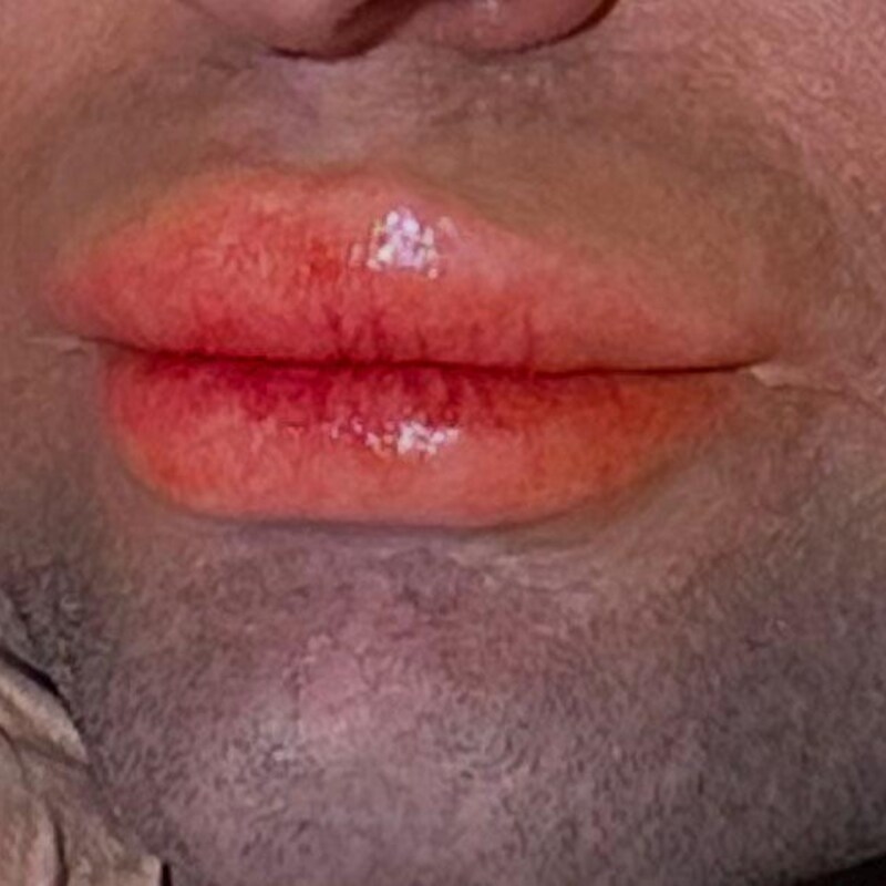 Prosthetic Lips - Etsy