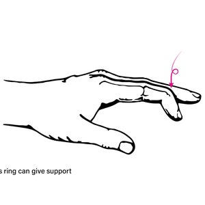 Adjustable Ring for Lateral Deviation, Bending Sideways Finger Splint ...