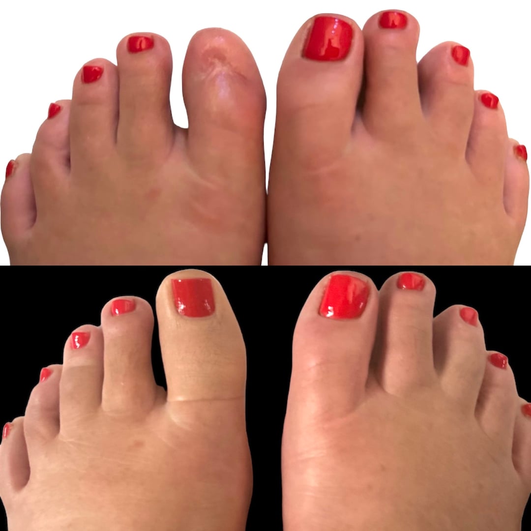 Completely Hollow Toe Sleeve With Red Nail Designed for Missing Toenail ...