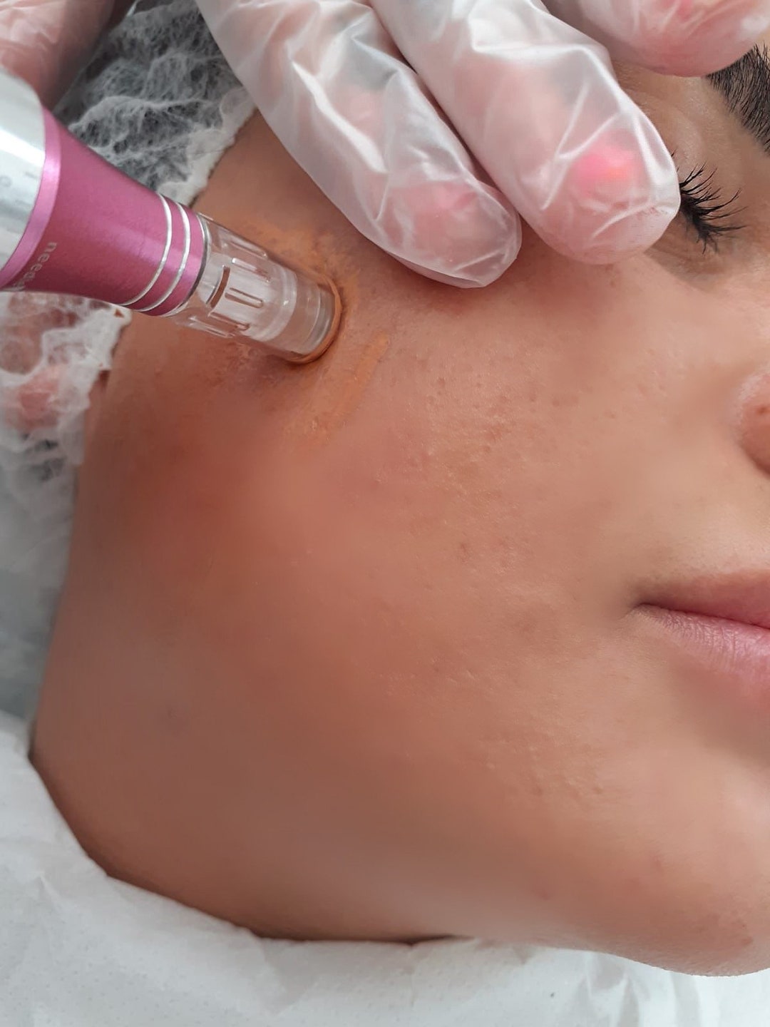 Micro Needling Learn How to Do Micro Needling Course Manual - Etsy