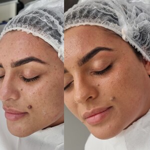 Micro Needling Learn How to Do Micro Needling Course Manual - Etsy