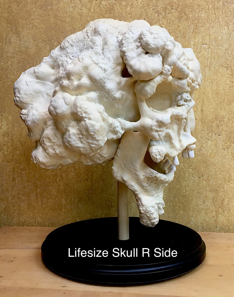 Joseph Merrick, the Elephant Man Life-size Skull Reproduction - Etsy