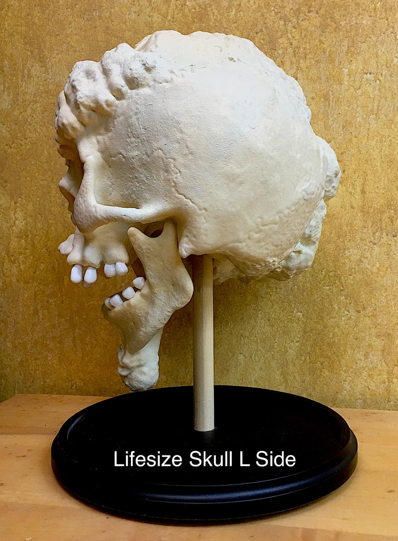 Joseph Merrick, the Elephant Man Life-size Skull Reproduction - Etsy