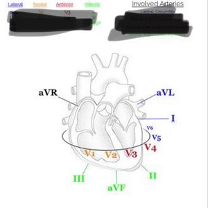 Cardiac STEMI Location Cheat Sheet | Etsy