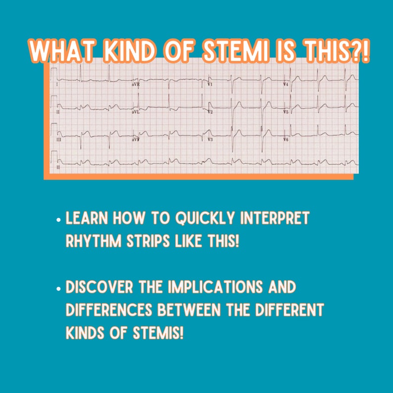 Cardiac Nursing Notes - STEMI Leads & CCRN Study Guide - CVICU Cheat ...