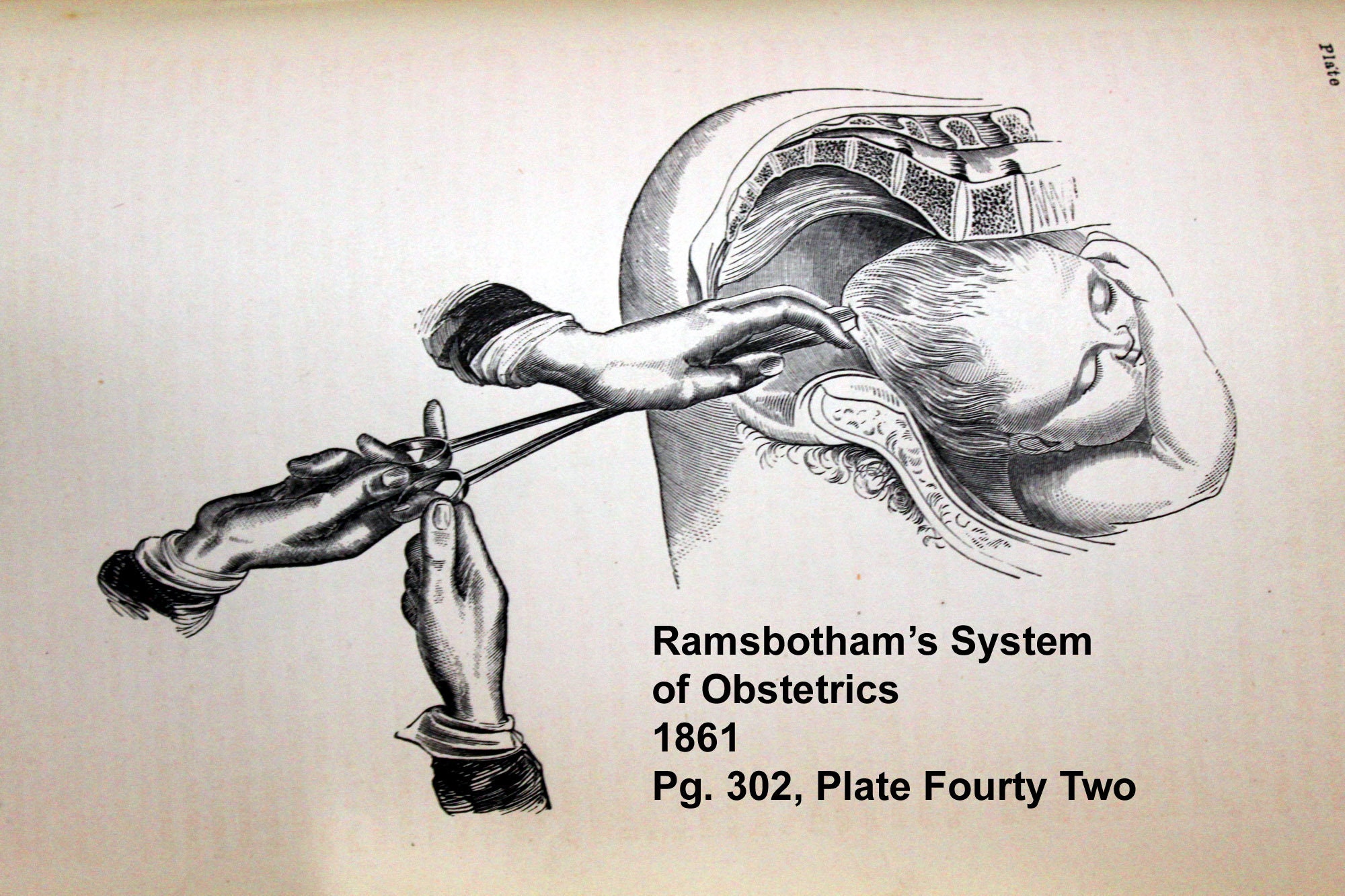 Vintage Obstetric Perforator Forceps - S Maw, Son & Thompson (sensitive ...