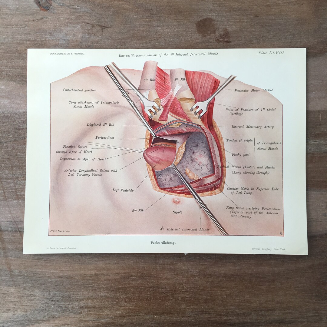 1906 Antique Anatomy Medical Print, Pericardiotomy Print, Anatomy Art ...