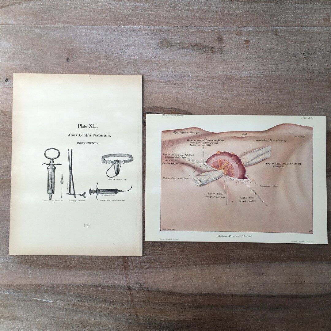 1906 Original Antique Anatomy Print Set of 2, Surgery Anus Contra ...