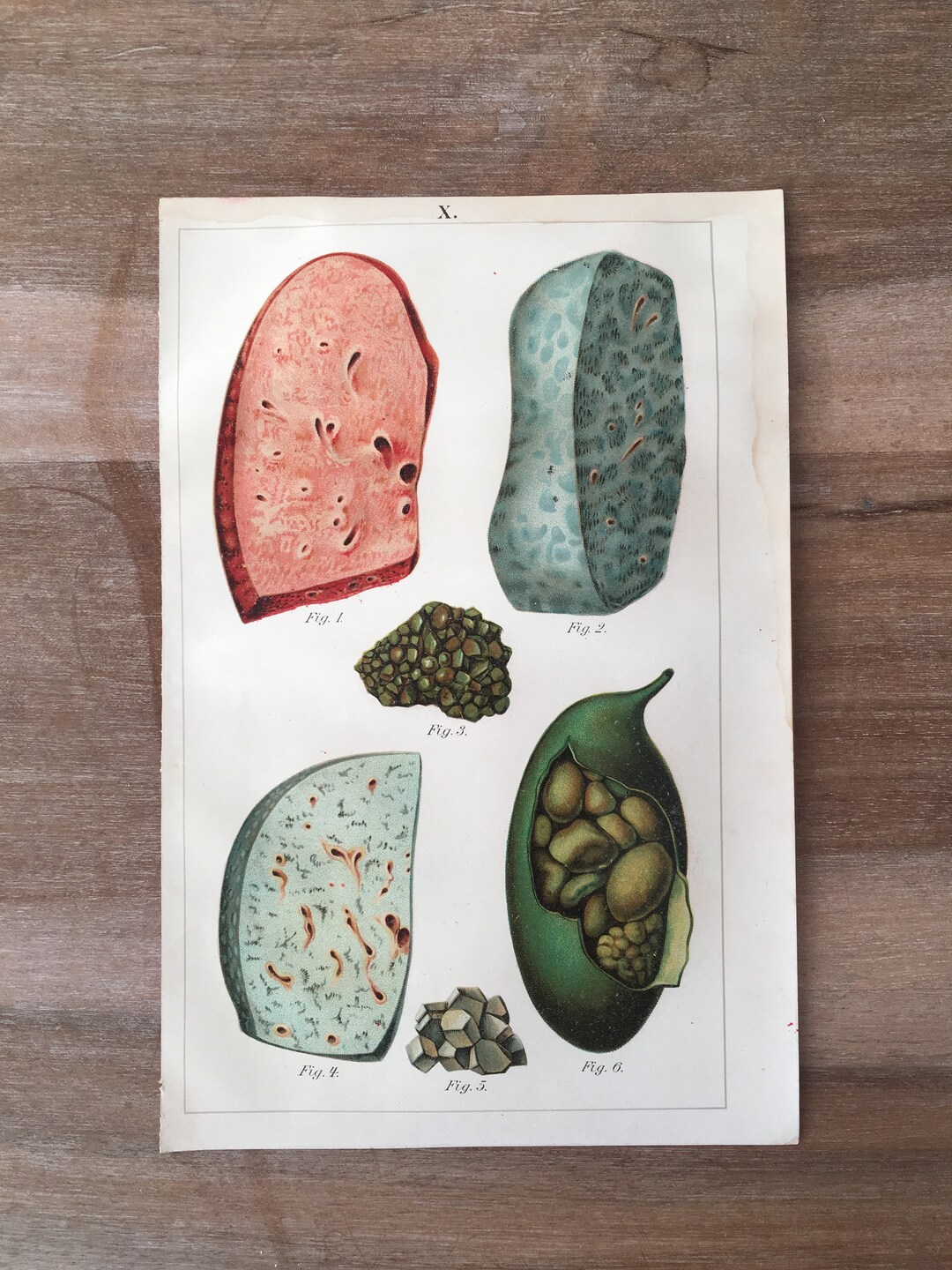 1900 Original Antique Lithograph With Lung and Gall Bladder Diseases ...