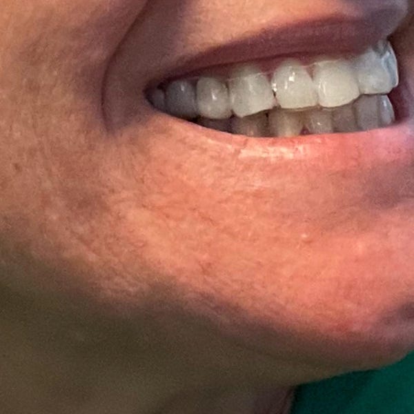 Retainers Customize for a Perfect Fit 1 Save Lots of Money and Office ...