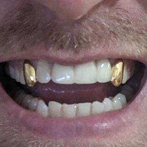 10K Gold Custom Grillz Two Front Teeth Real Solid Gold Double - Etsy