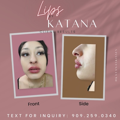 Hyaluron Pen Lip Mapping, Lip Filler Mapping, Russian Lip Technique ...