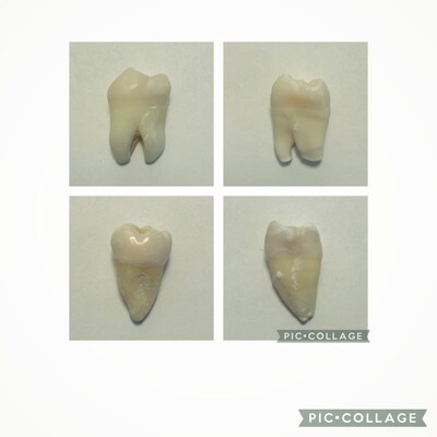 10 CRACKED AND BROKEN Real Human Teeth Molars, Premolars, & Anteriors ...