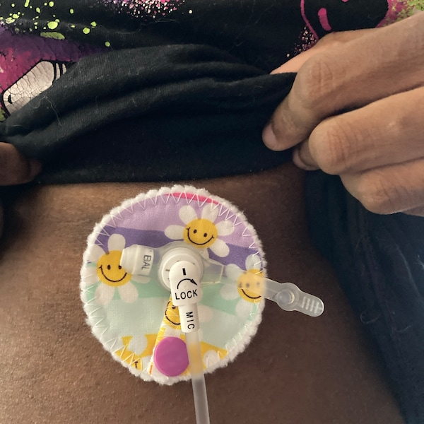 Gtube Pads , Buttons Feeding Tube G-tube Mic-key Button Feeding Tube ...