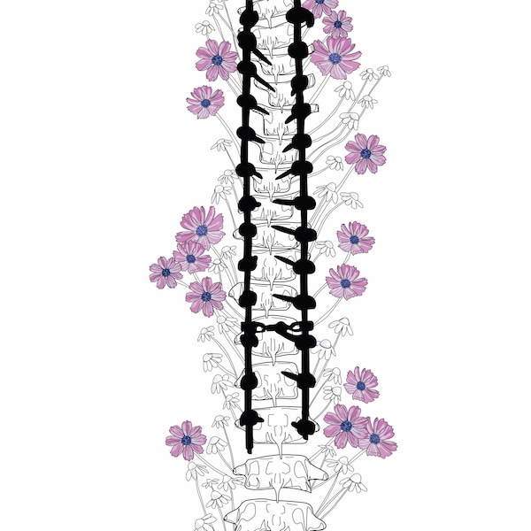 Custom Scoliosis / Spinal Fusion Digital Art Print PRINTABLE File ...